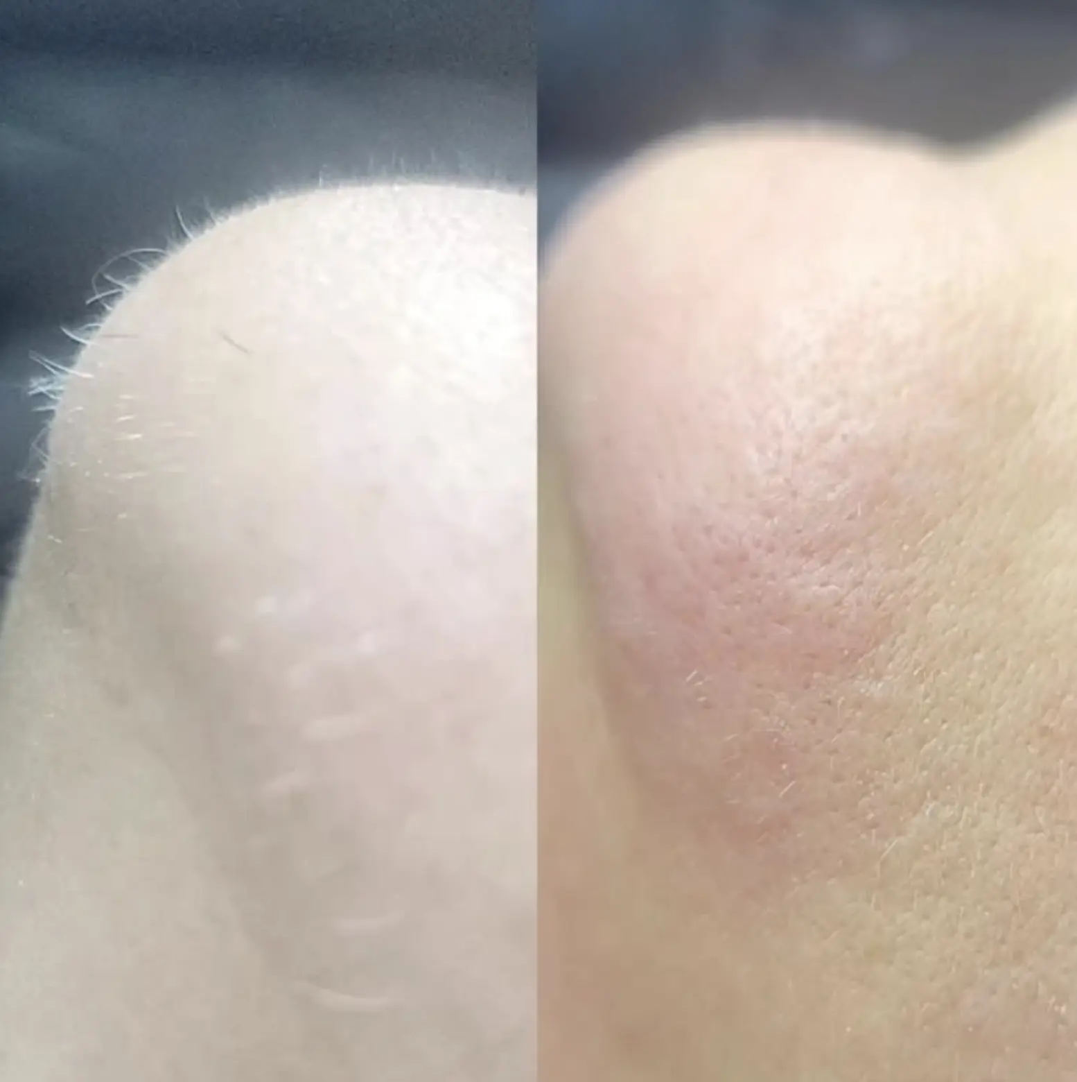 Does Laser Hair Removal Cause Cancer?