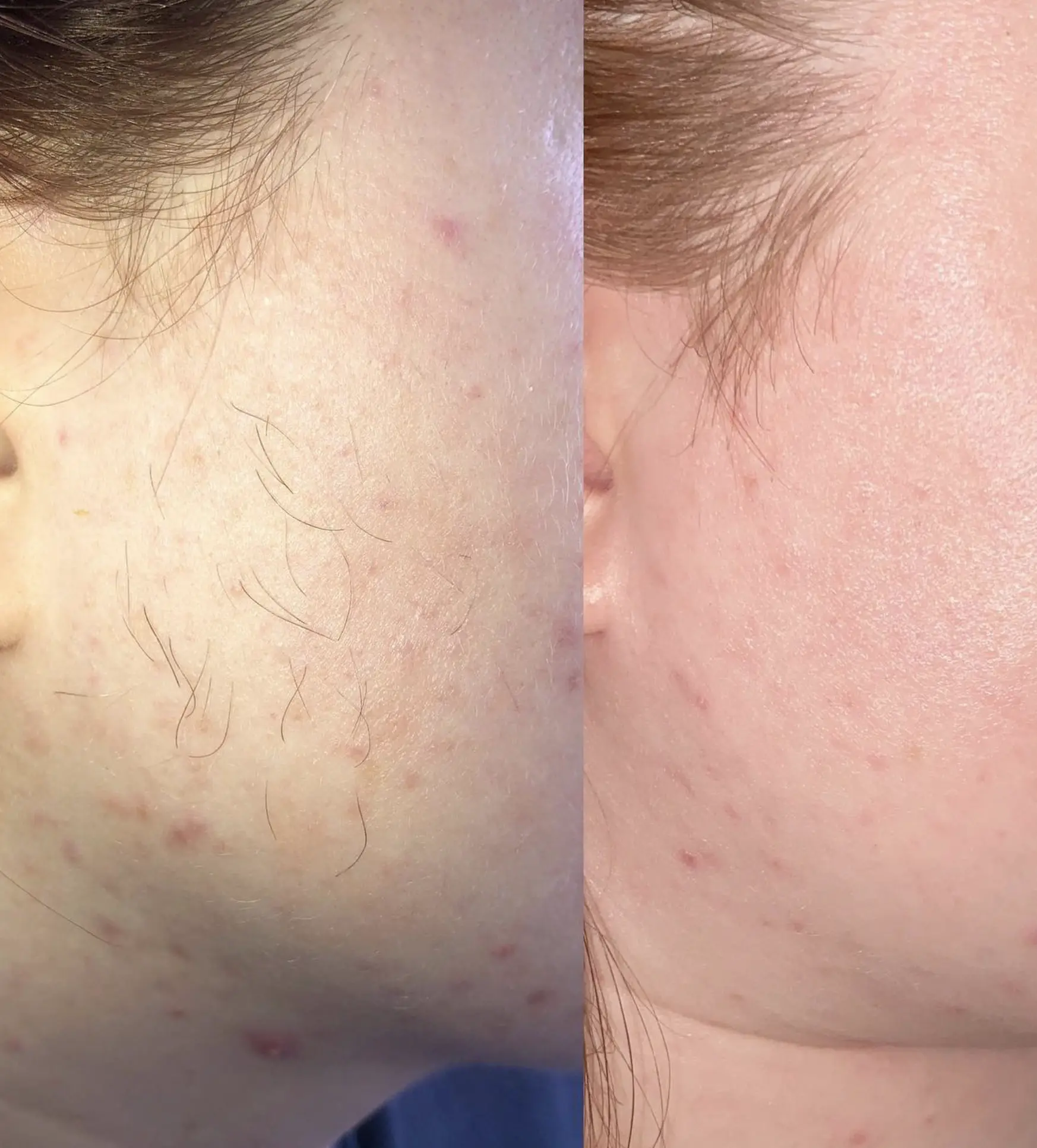 Does Laser Hair Removal Cause Cancer?